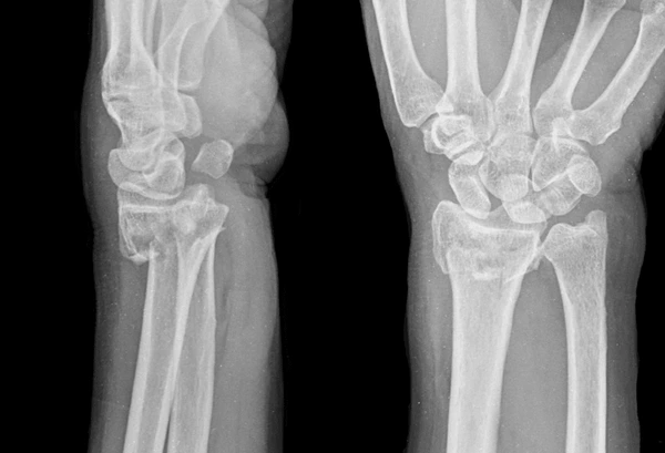 Distal radius growth arrest - Best Pediatric Orthopaedic In Noida