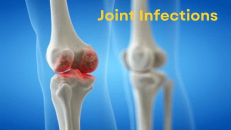 Joint Infections - Best Pediatric Orthopaedic In Noida
